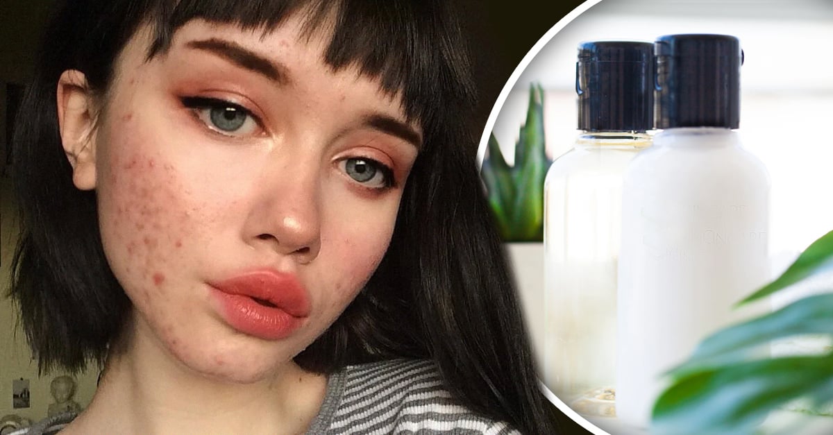 6 Activos contra el acné que debes de probar inmediatamente