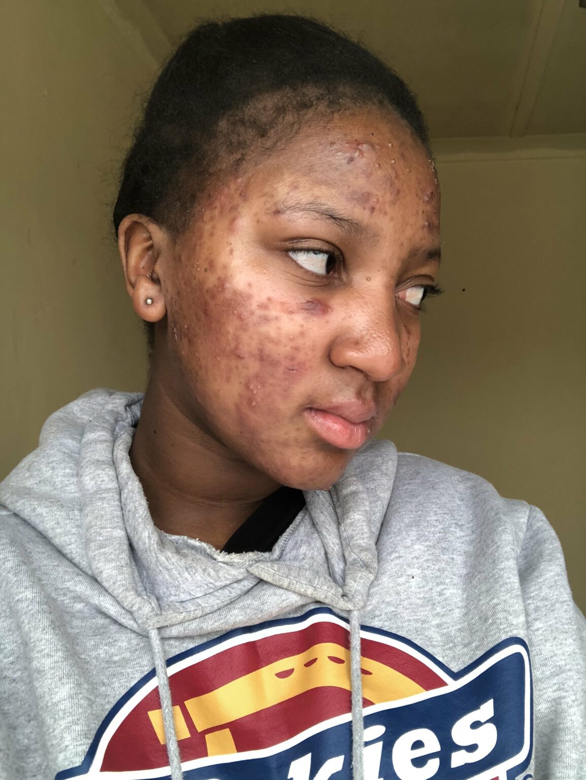 Chica muestra su antes y después de padecer acné severo