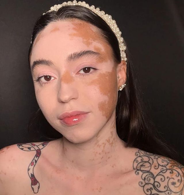 Woman With Vitiligo Overcomes Confidence Issues After Becoming A Model ...