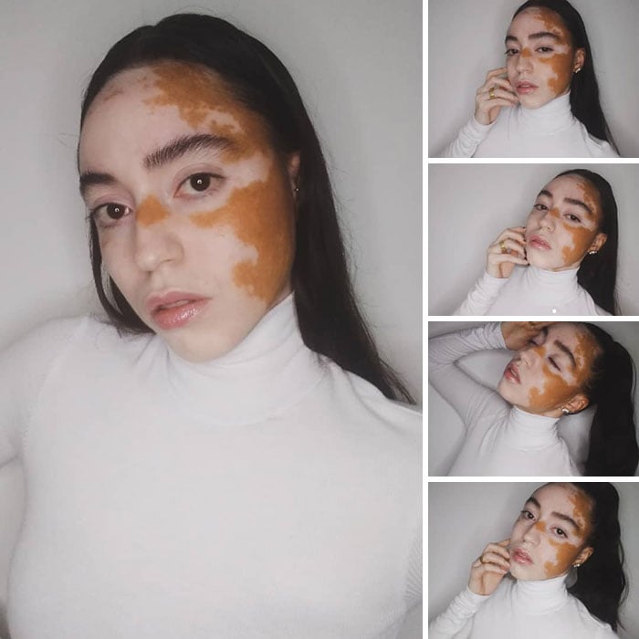 Woman With Vitiligo Overcomes Confidence Issues After Becoming A Model ...