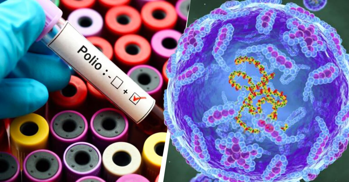Polio reaparece; confirman el primer caso en casi una década