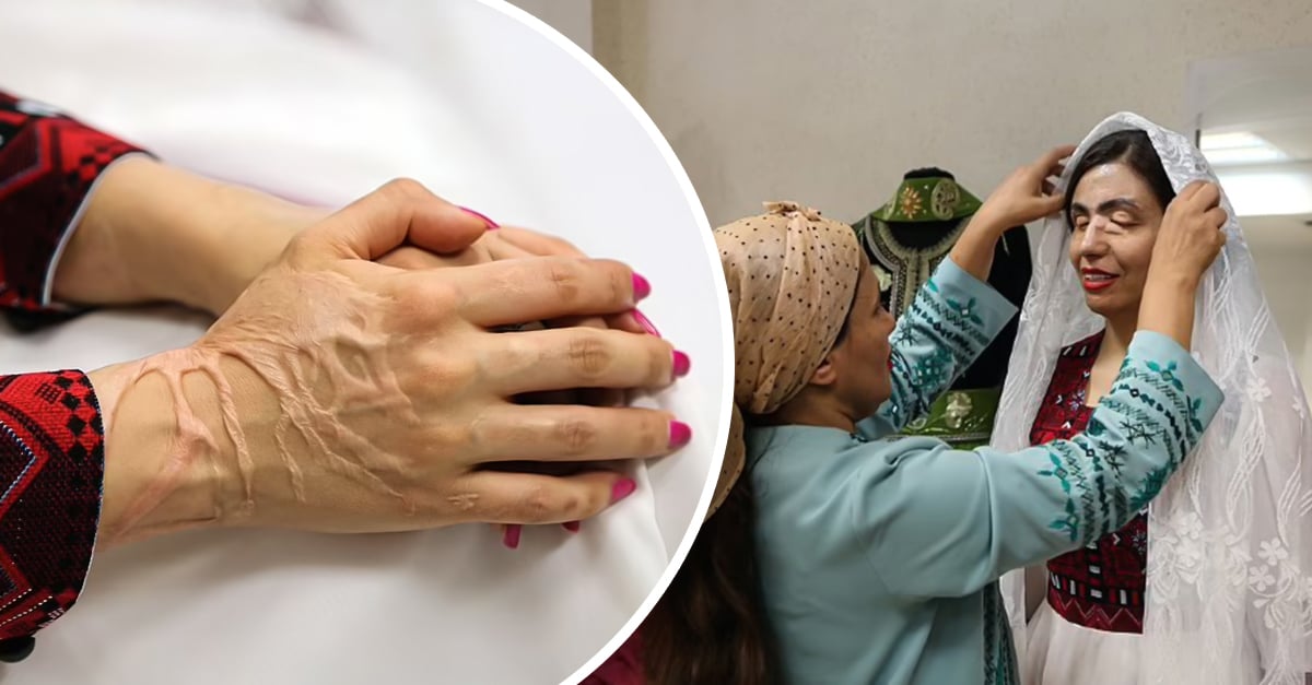 Acid Attack Victims Now Role Models; beautiful inside and out | World ...