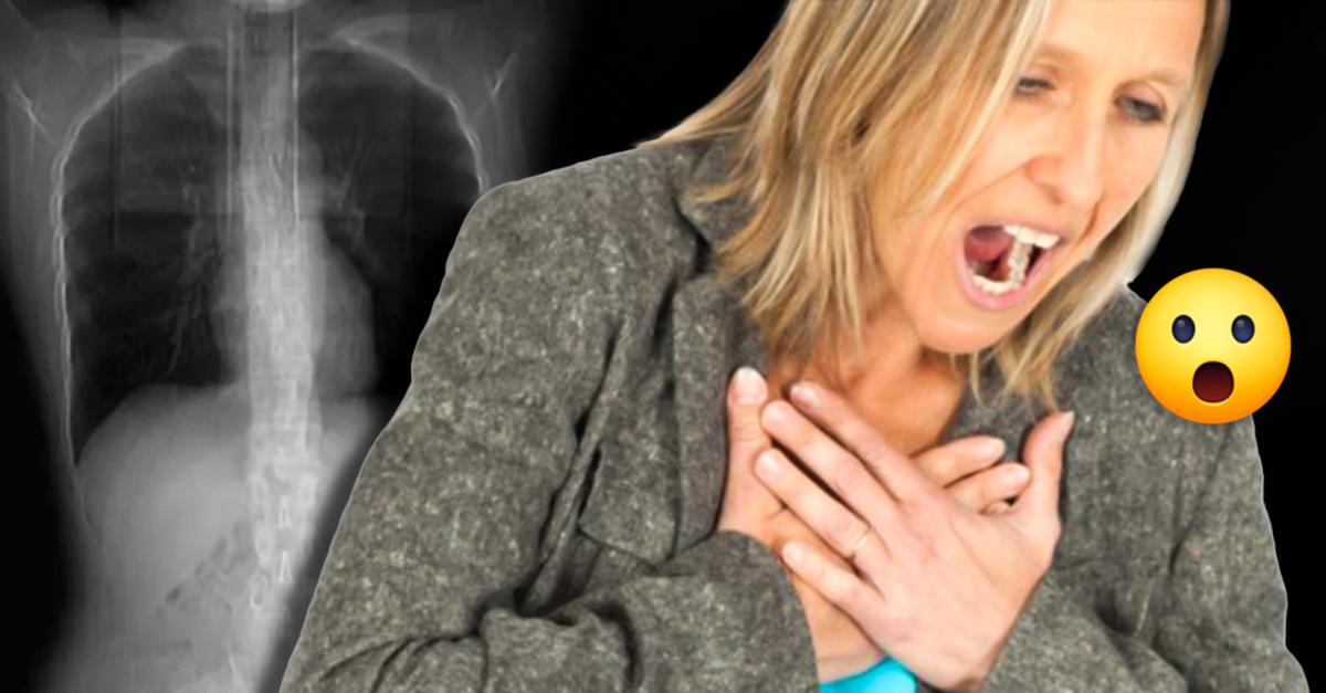 Mujer tosió tan fuerte que se rompió cuatro costillas