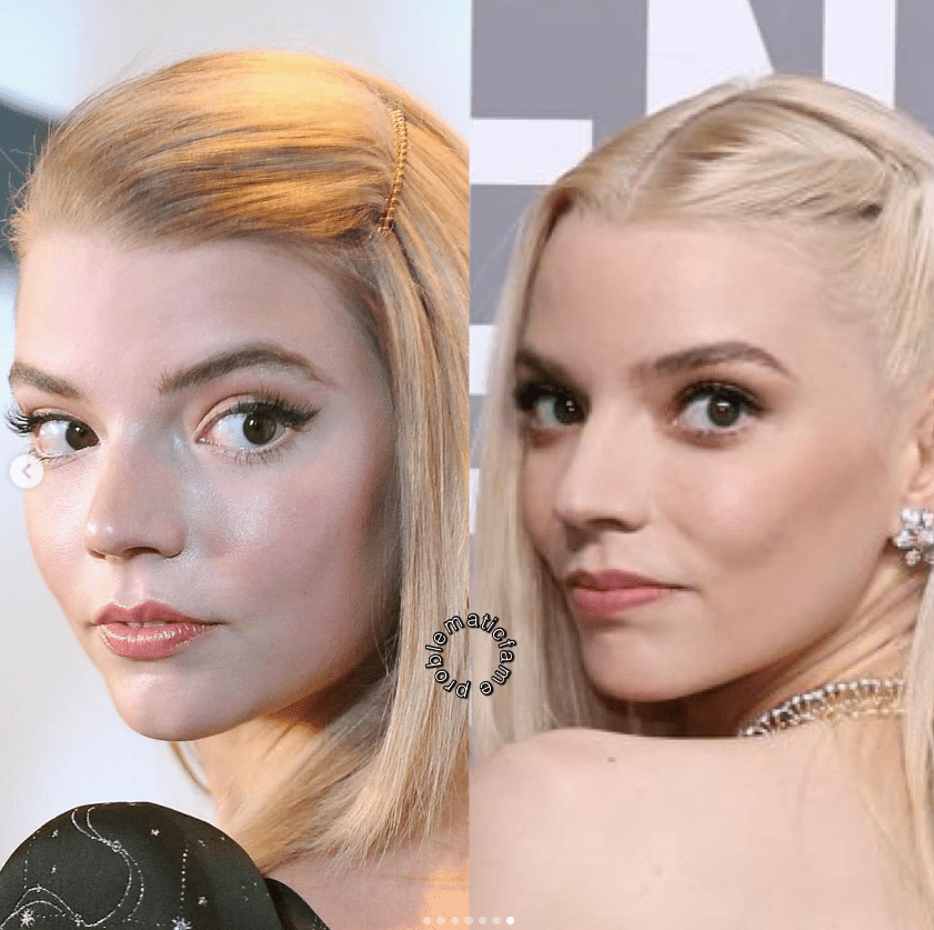 This is the surgery radically changed the face of Anya Taylor-Joy ...