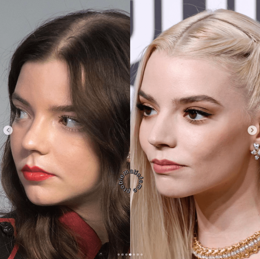 This is the surgery radically changed the face of Anya Taylor-Joy ...